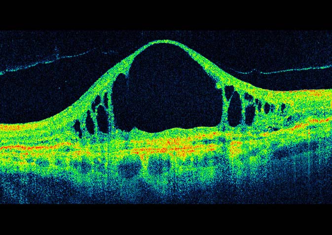 EYE POSTERIOR SEGMENT SURGERY